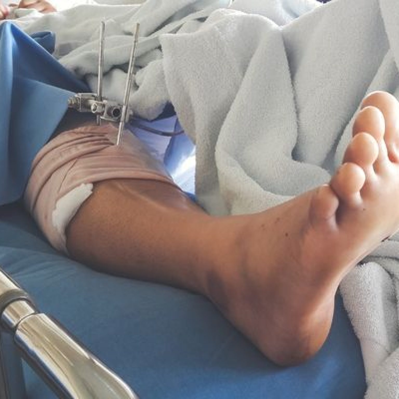 What Types of Serious Injuries Commonly Occur in Accidents