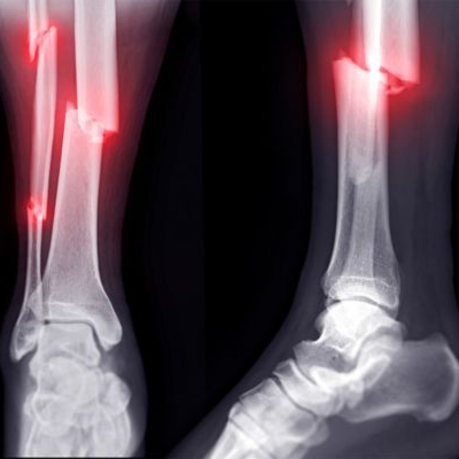 Common Types of Fractures Sustained in an Accident